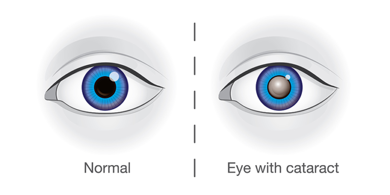 Cataract Evaluations and Surgical Consultations | Southwest Vision